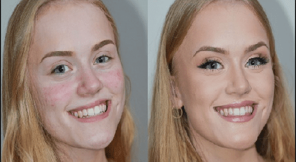 İsotrexin Jel Neye İyi Gelir? | Kombin Kadın