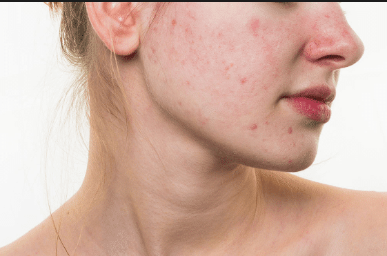 İsotrexin Jel Neye İyi Gelir? | Kombin Kadın