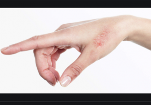 Betnovate Krem Neye Yarar, Yorumlar? | Kombin Kadın