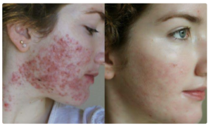 Zoretanin Ne İçin Kullanılır, Yan Etkileri? | Kombin Kadın