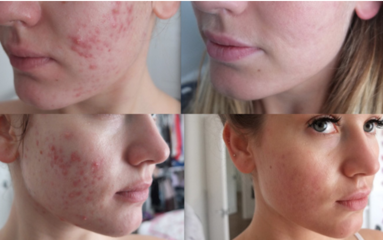 Zoretanin Ne İçin Kullanılır, Yan Etkileri? | Kombin Kadın